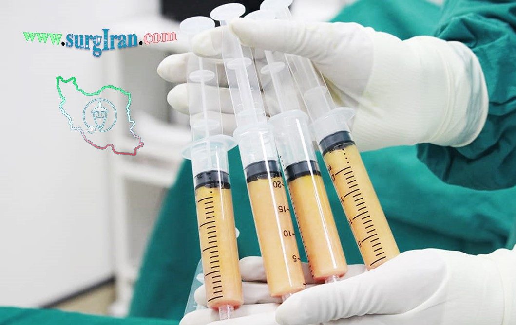 What You need to know about Fat Transfer - SurgIran Group-